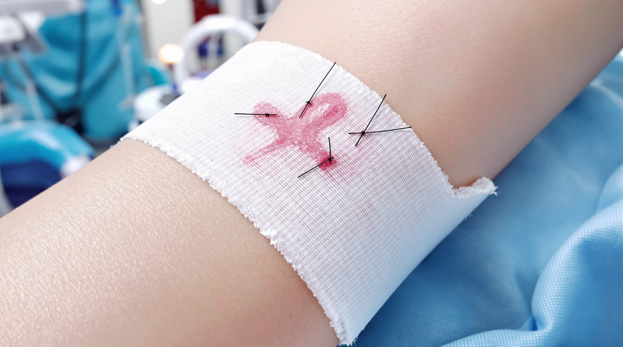 Stitches 🧵: Guide to healing stages and times