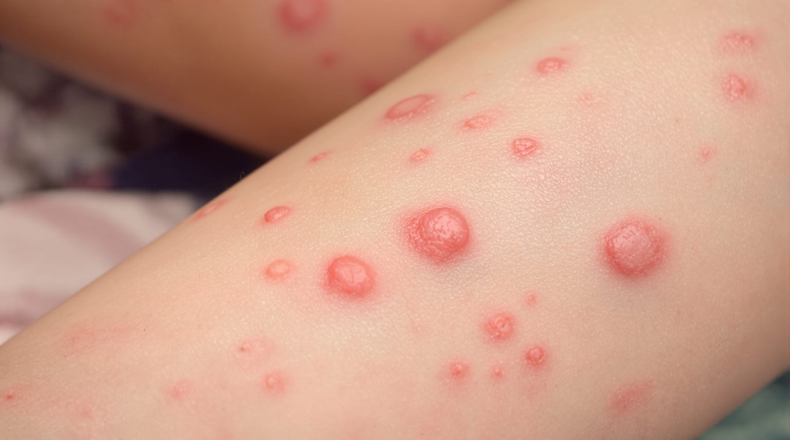 Urticaire cutanée : symptômes, causes et solutions 🌿🤔